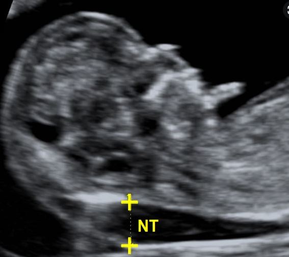1-Fetal Screening